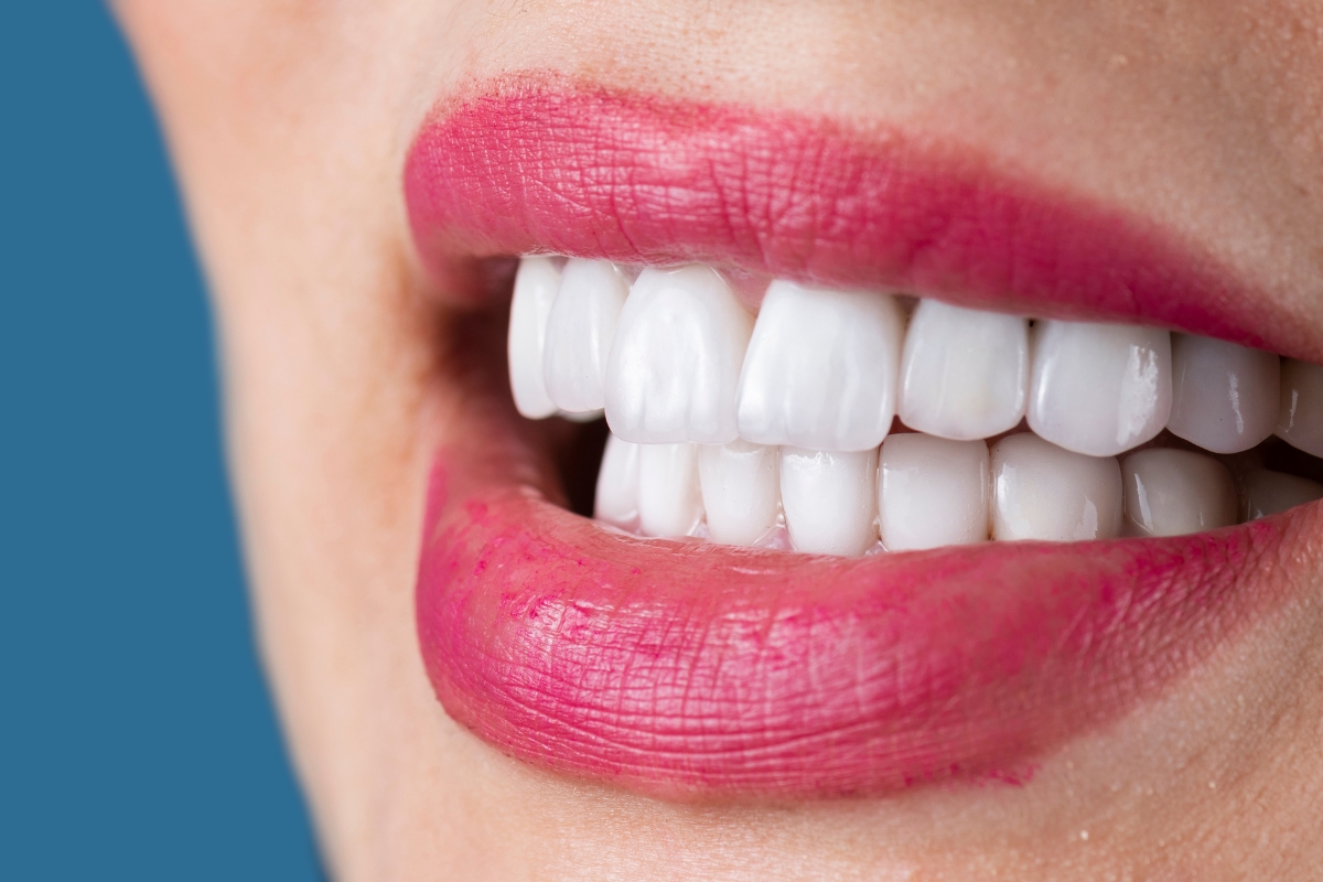 Bioclear vs Veneers: Dr. Nguyen’s Guide